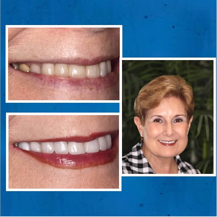 General & Cosmetic Dentistry Before & After Pictures from FL Dentist