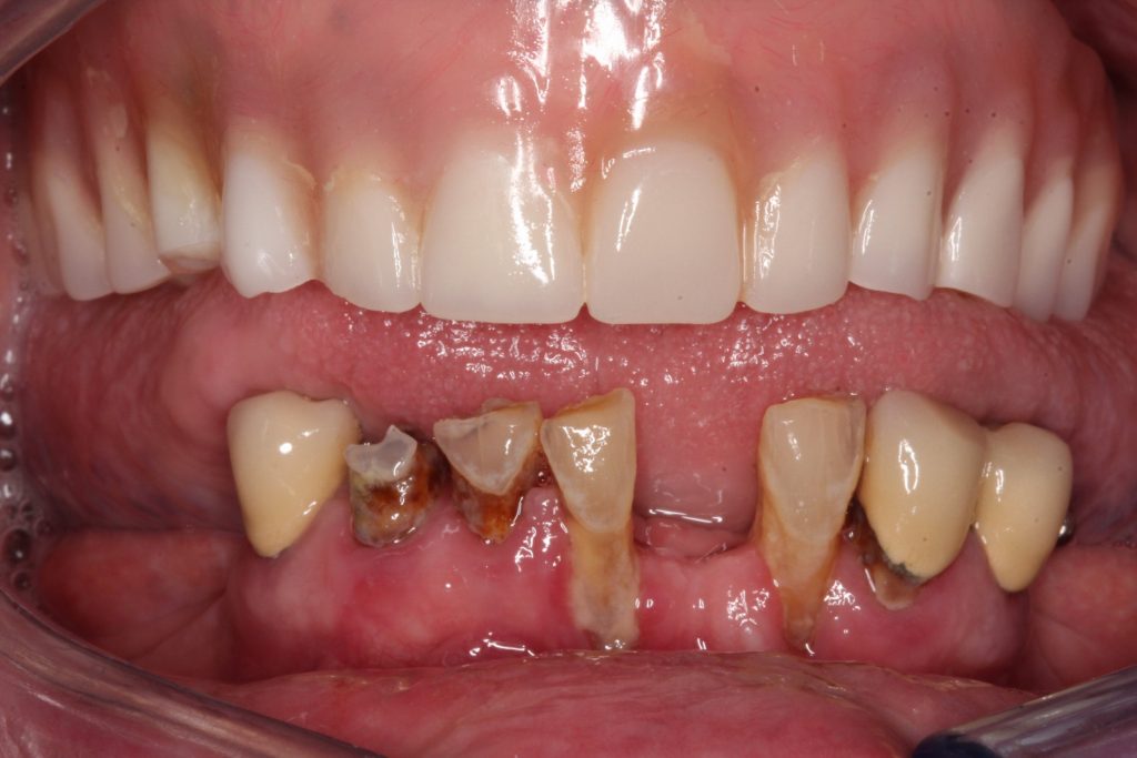 Implant Supported Over-Dentures Wellington FL | Hybrid Over Denture