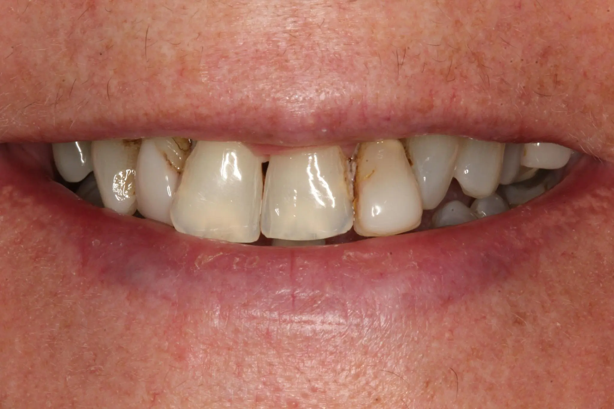 Implant Supported Over-Dentures Wellington FL | Hybrid Over Denture