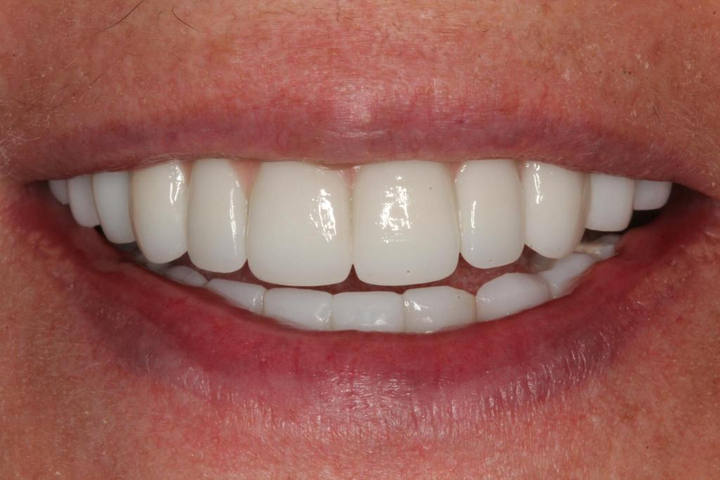 Implant Supported Over-Dentures Wellington FL | Hybrid Over Denture