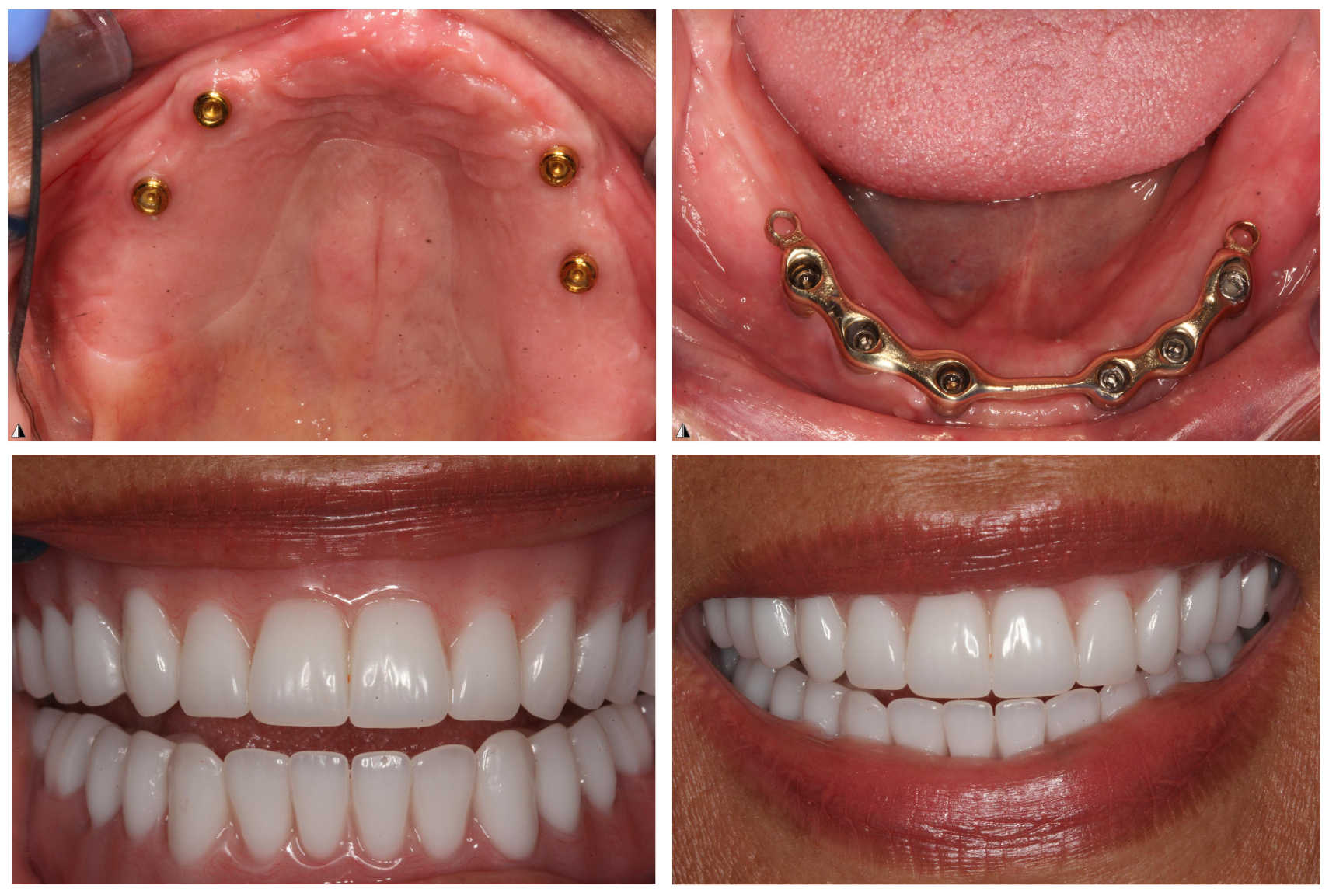 Implant Supported Over-Dentures Wellington FL | Hybrid Over Denture